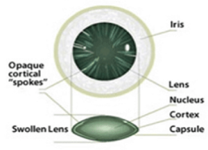 What is Cataract- Causes, Types, Cost & Treatment