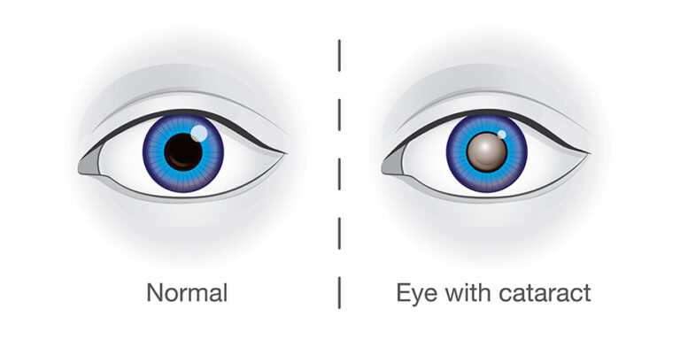 Different Types of Cataracts: Signs, Causes & Ways To Prevent!