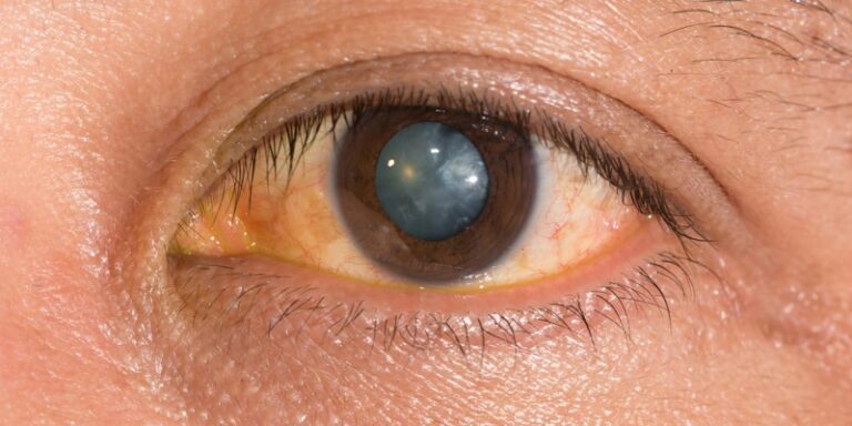 Nuclear Cataract: Signs, Causes and Treatment