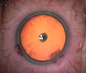Posterior Subcapsular Cataract: Signs, Causes and Treatment