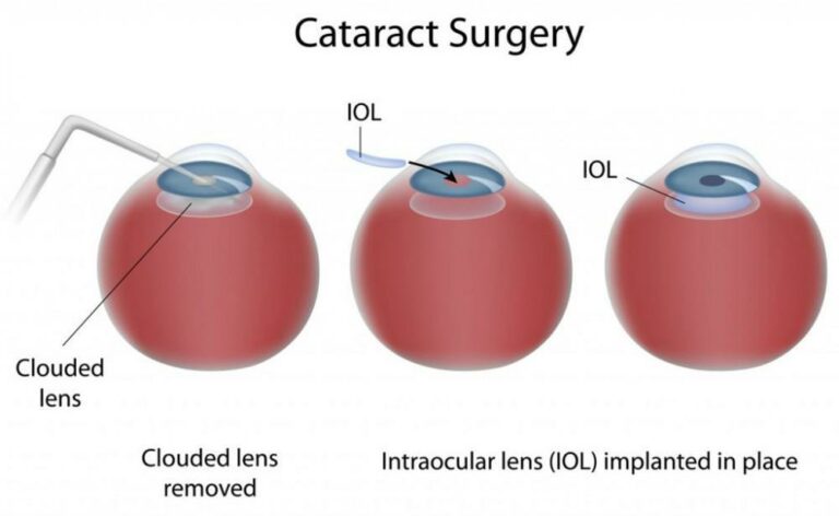 Extracapsular Cataract Extraction: Techniques, Uses and Benefits