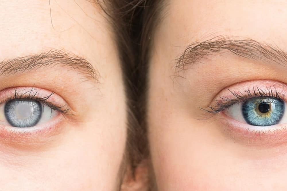 Early Onset Cataracts: Signs, Causes and Treatment Options