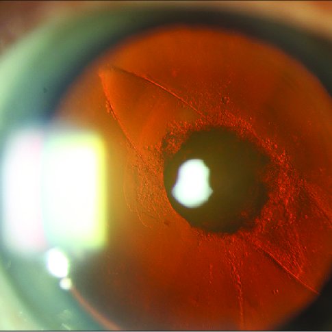 Posterior Polar Cataracts | Treatment For Posterior Polar Cataracts