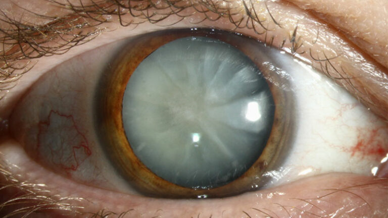 Nuclear Cataract: Signs, Causes and Treatment