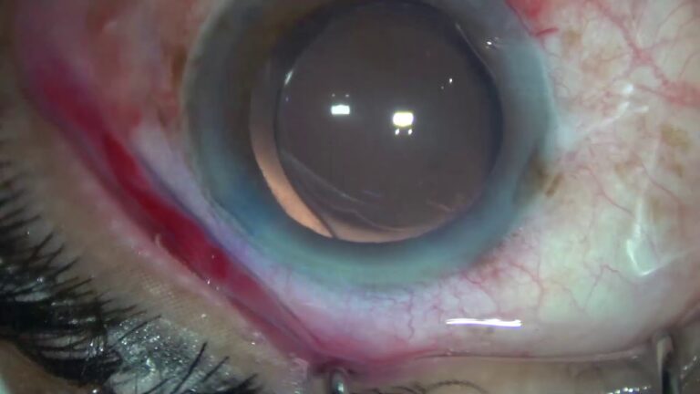 Immature Senile Cataract: Symptoms, Causes & Treatment