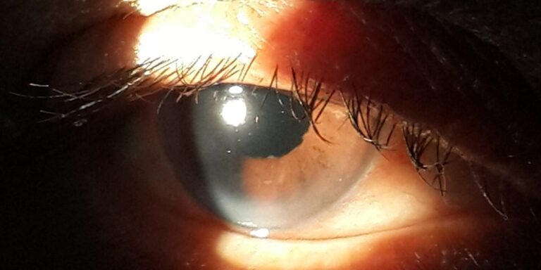 Posterior Subcapsular Cataract: Signs, Causes and Treatment