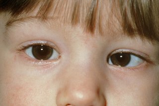 Cataracts In Children: Causes, Treatment, Prevention