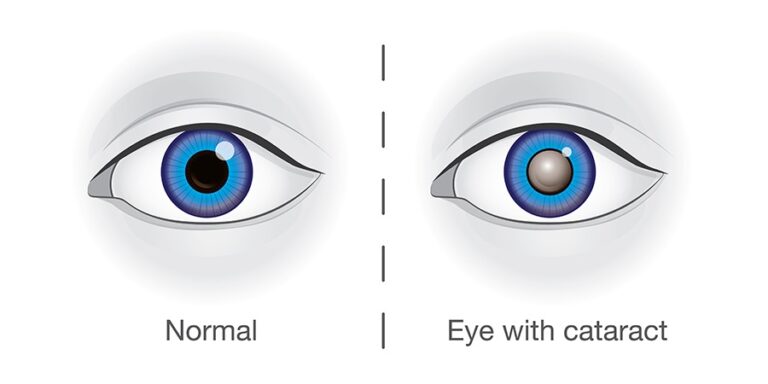Right Eye Cataract: Common Signs, Diagnosis And Treatment