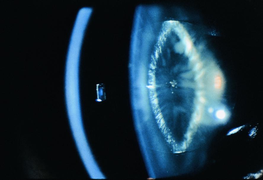 Lamellar Cataract: Meaning, Symptoms, Causes And Treatment