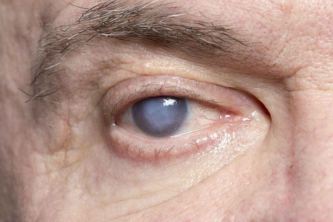 Congenital Cataract: Signs, Causes and Treatment
