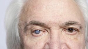 Intumescent Cataract: Signs, Causes, Impacts, And Treatment