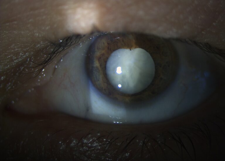 Stellate Cataract: Comprehensive Guide On This Cataract