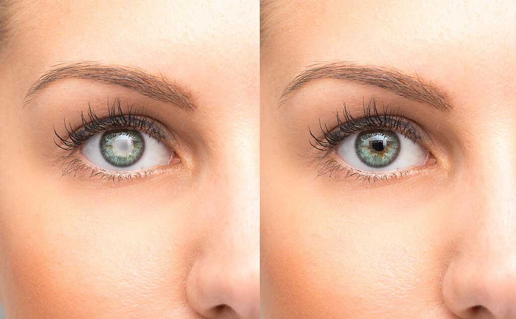Nuclear Sclerotic Cataract: Signs, Causes, Treatment Options